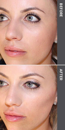 Treatments: Cheek Enhancement - Heart Aesthetics